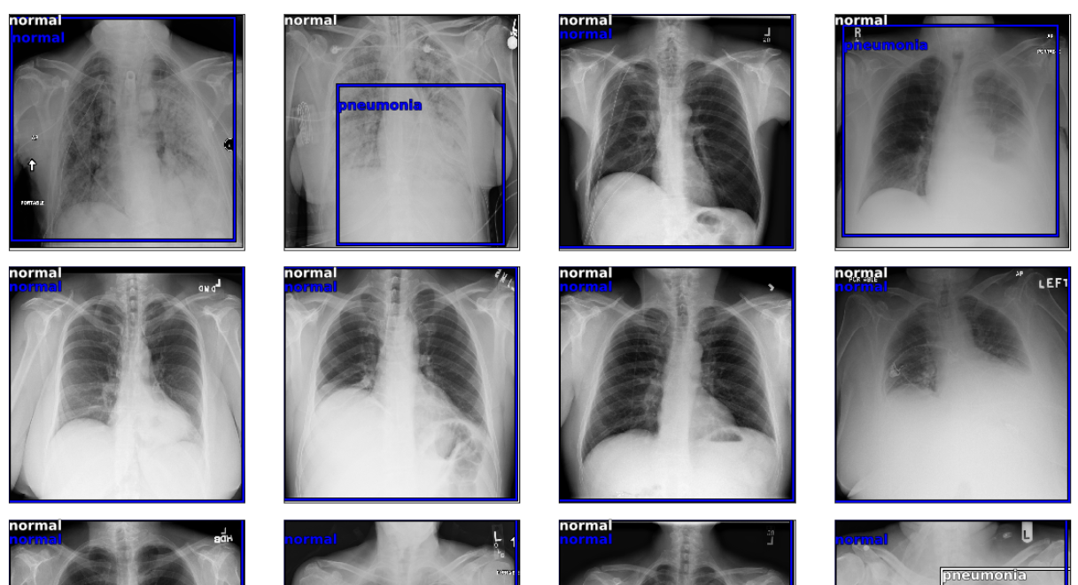 Detecting Pneumonia in chest radiographs with fast.ai
